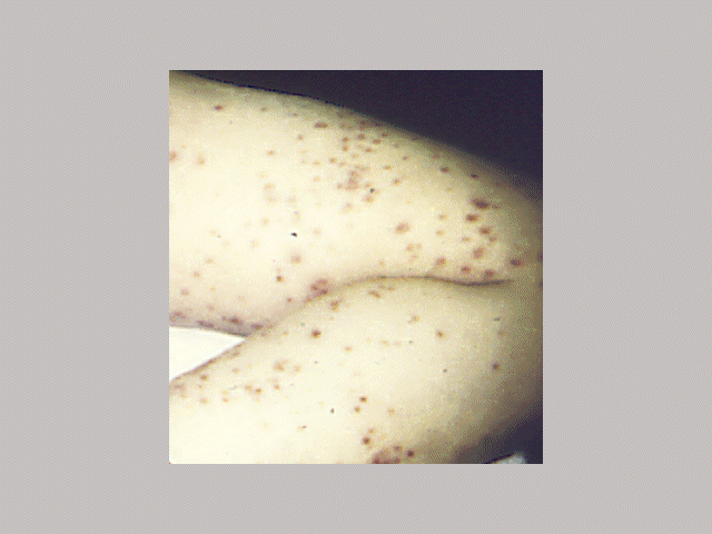 Florid Rash Caused by Vitamin B12 Injections Administered by Nurse in ...